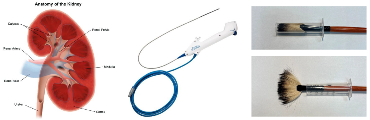 Duster Buster: Endourological Device To Remove Stone Fragments From ...